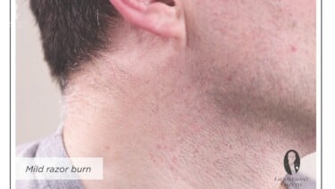 Why Is A Double-Edged Safety Razor Better Than Cartridge Or Electric?